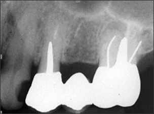 Normal Radiographic Appearance of the Supporting Structures of the ...