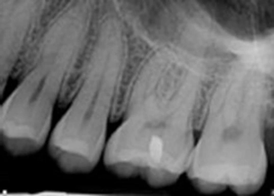 Normal Radiographic Appearance of the Supporting Structures of the ...