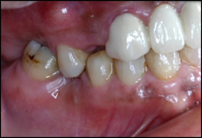 Contraindications for Non-metal clasp dentures (NMCD) | Non-Metal Clasp ...