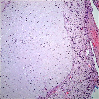 Diagnostic Information | Smooth-surfaced Nodule on the Ventral Tongue ...
