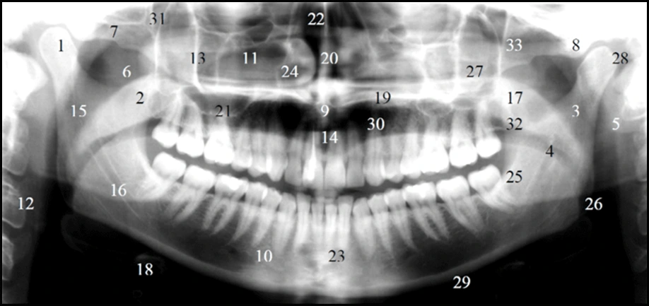 Features of an Optimal Panoramic Radiograph - Practical Panoramic ...