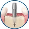 Restorative Dentistry - Tooth Restoration Techniques | Dentalcare