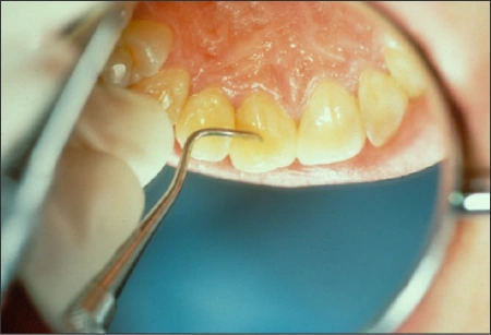 Nevi Scalers - Advanced Instrumentation for the General Practice Dental ...