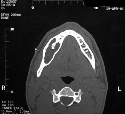 Diagnostic Information | The Case of a Subtle Expansion of the Mandible ...