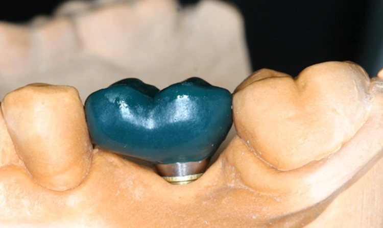 Establishing Proper Communication with the Implant Surgeon and ...