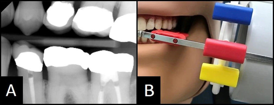 Problem #4: Bitewing Images Not Ideal | Intraoral Imaging Techniques: Beyond the Textbook ...