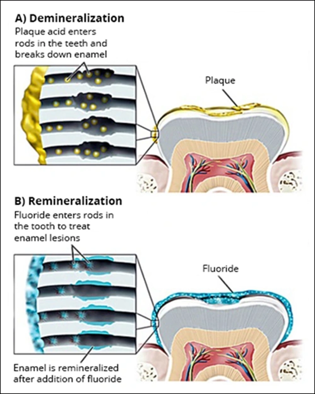 The Caries Process & Fluoride’s Mechanism of Action | A-Z Fundamentals ...