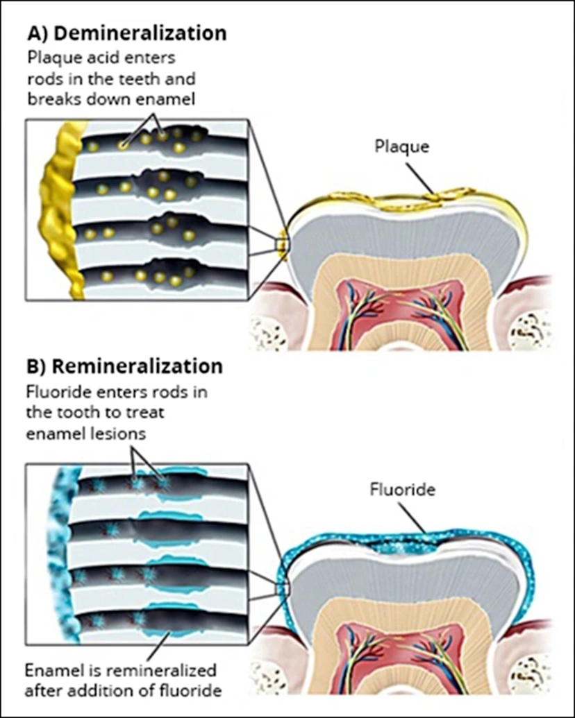 The Caries Process & Fluoride’s Mechanism of Action | A-Z Fundamentals ...