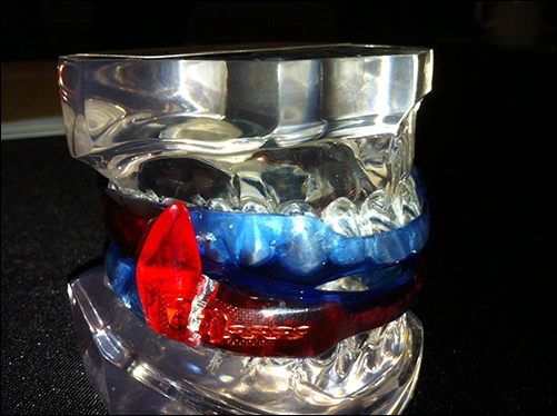 Selection of the MAD Device - Sleep Apnea Management for the Dentist ...