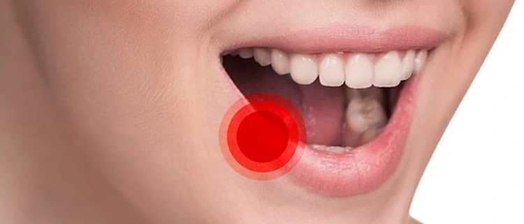 What Causes Cold Sores? How to Treat & Prevent Cold Sores | Dentalcare