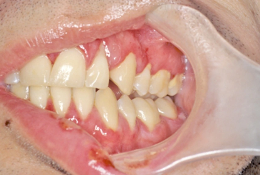 Viral Diseases | A Guide to Clinical Differential Diagnosis of Oral ...