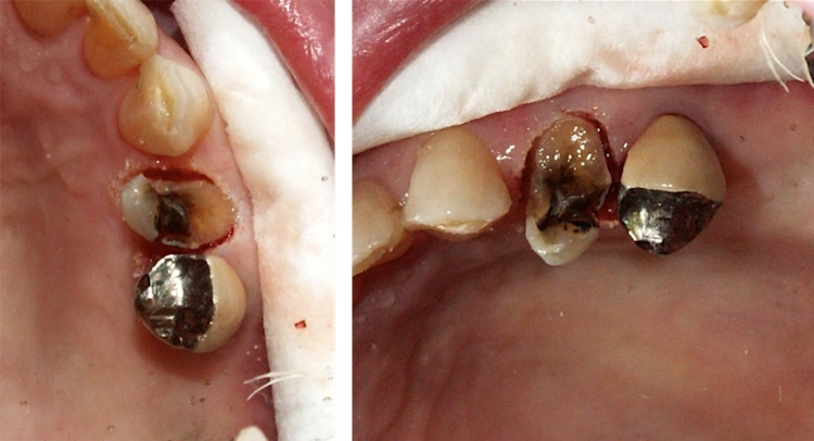 Minimal Flap Crown Lengthening | Lasers in Dentistry: Minimally ...