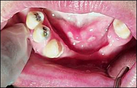 Floor of the Mouth - The Intraoral and Extraoral Exam - Dentalcare