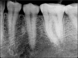 Attrition - Anomalies of Tooth Structure - Dentalcare
