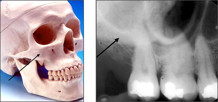 Maxillary Posterior Landmarks - Intraoral Radiographic Anatomy - Dentalcare
