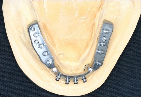 Fifth Clinical Appointment - Full Arch Implant Prostheses: Part II ...