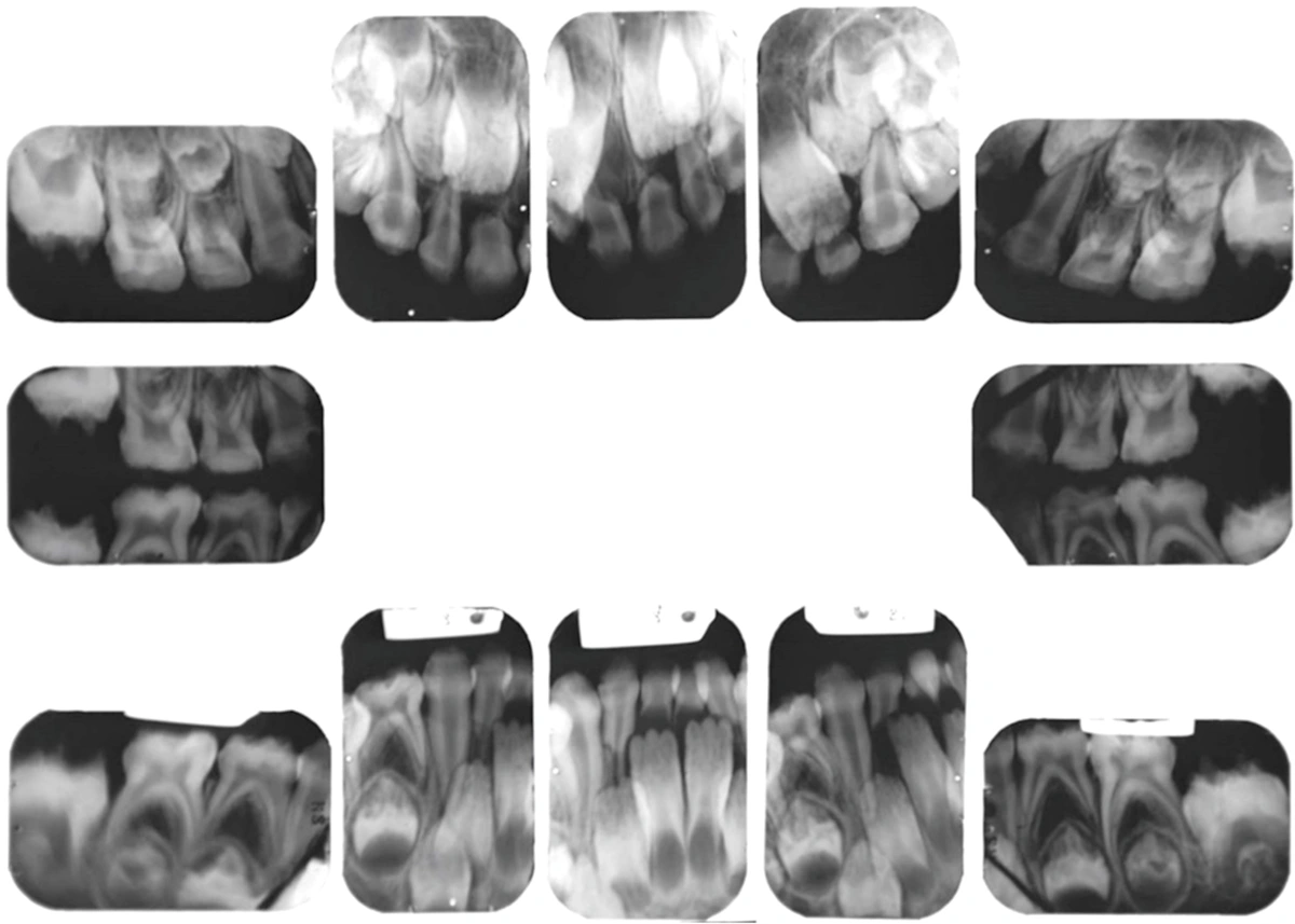 Loss of Tooth Structure - Anomalies of Tooth Structure - Dentalcare