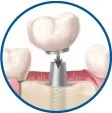 Restorative Dentistry - Tooth Restoration Techniques | Dentalcare
