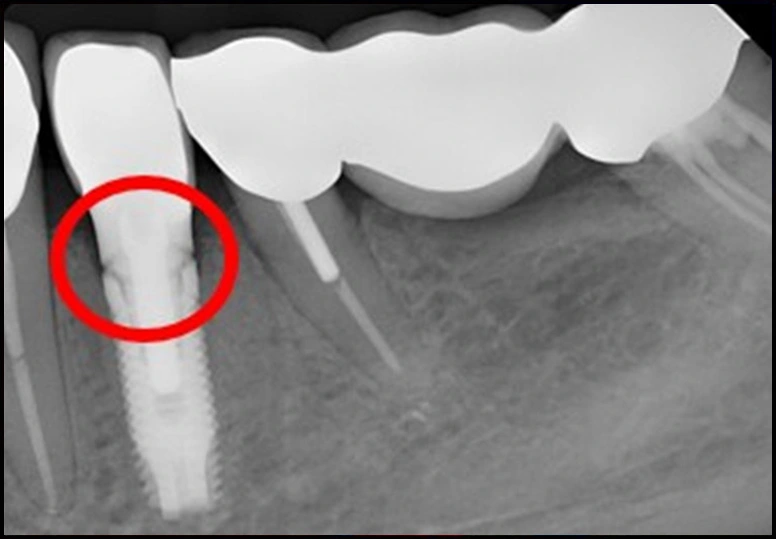 Problem #7: Images for Implant Procedures | Intraoral Imaging ...