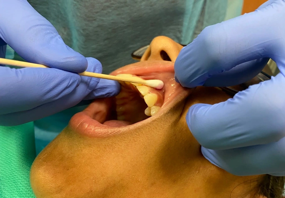 Apply Topical Anesthetic - Local Anesthesia in Pediatric Dentistry ...