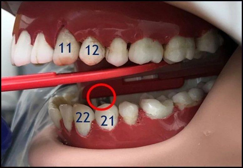 Problem #3: Fail to Capture Distal of Canine on Premolar Bitewing Image ...