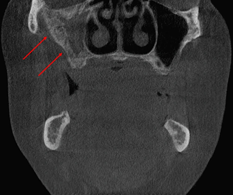 Paranasal Sinuses - Cone-Beam Computed Tomography (CBCT) Applications ...