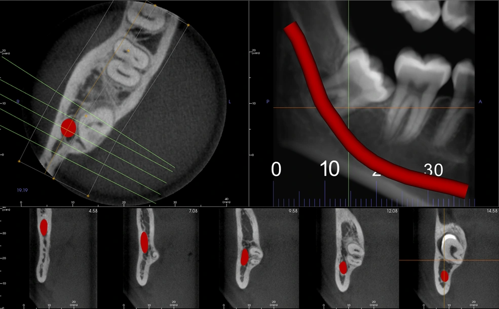 Pre-surgical Evaluation - Cone-Beam Computed Tomography (CBCT ...
