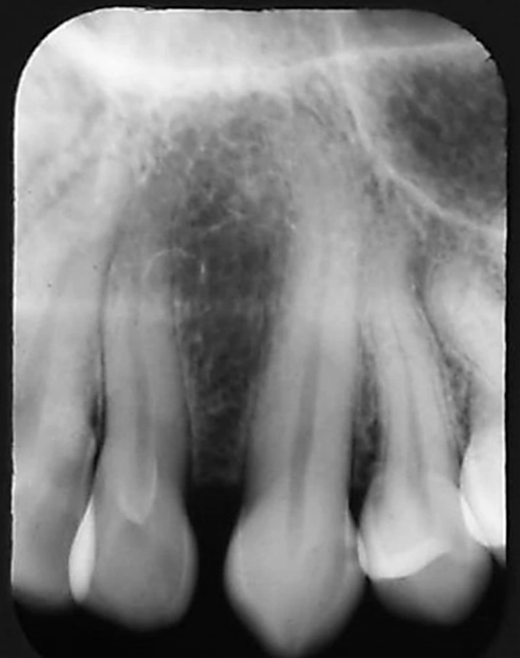 Accessory Cusps - Anomalies of Tooth Structure - Dentalcare
