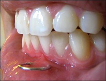 Definition of Oral Piercing - Oral Piercings: Implications for Dental ...