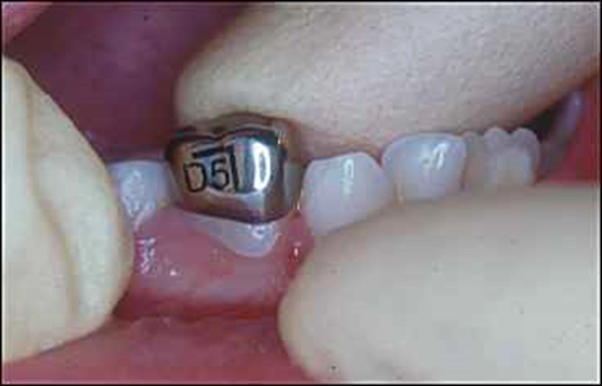 Hall Technique Stainless Steel Crowns - Smiles For Tomorrow - Dentalcare