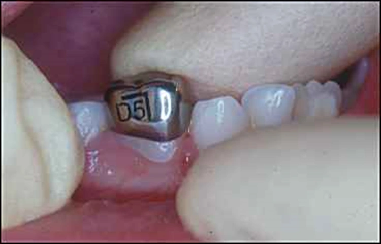 Hall Technique Stainless Steel Crowns - Smiles For Tomorrow - Dentalcare