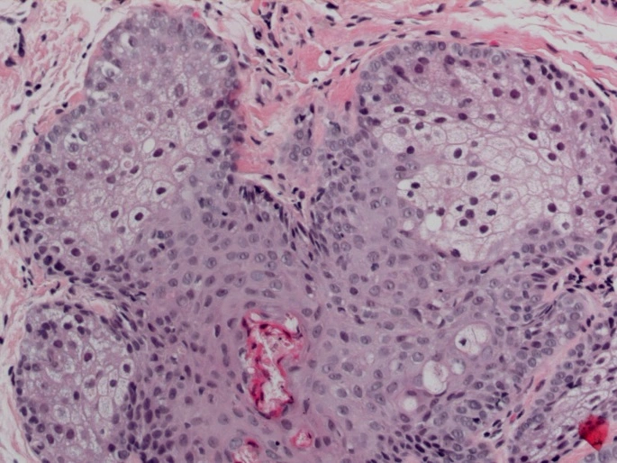Diagnostic Information | Incidental Yellow Papules in the Upper Lip ...