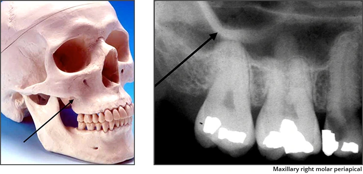 Maxillary Posterior Landmarks - Intraoral Radiographic Anatomy - Dentalcare