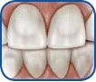 Types Of Tooth Stains - How To Whiten Your Teeth? | Dentalcare