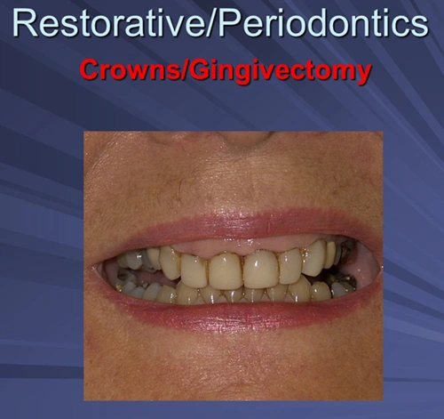 Gingivectomy | Lasers in Dentistry: Minimally Invasive Instruments for ...
