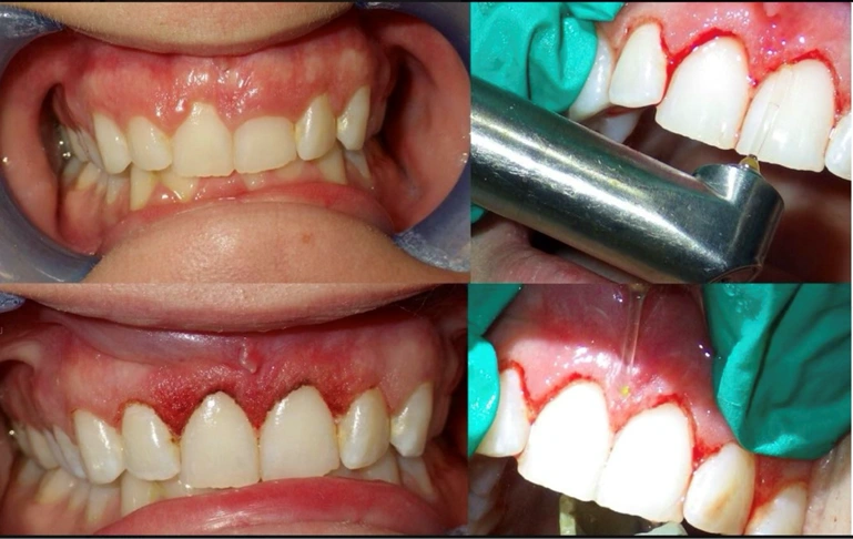 Gingivectomy | Lasers in Dentistry: Minimally Invasive Instruments for ...