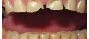 Erosion & Hypersensitivity Treatment - Stannous Fluoride Toothpaste ...
