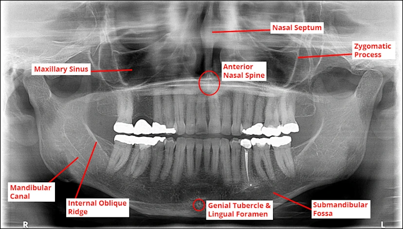 Review of Normal Anatomical Landmarks and Variations - Panoramic ...