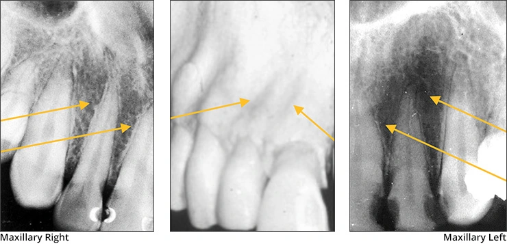 Maxillary Anterior Landmarks - Intraoral Radiographic Anatomy - Dentalcare