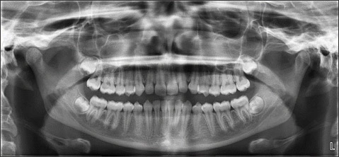 Adolescent with Permanent Dentition prior to the Eruption of Third ...