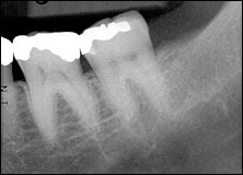 Diagnostic Information | Persistent Painful Ulcer of the Posterior ...