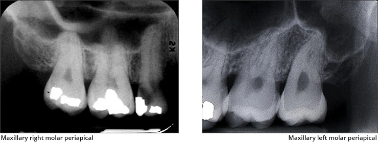 Maxillary Posterior Landmarks - Intraoral Radiographic Anatomy - Dentalcare