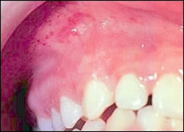 Extravascular Blood Lesions | A Guide to Clinical Differential ...