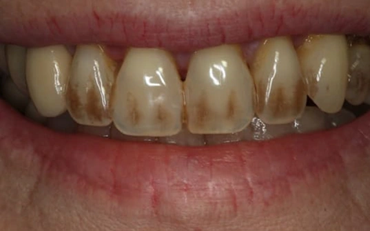 Chromogens On and In Teeth – Definitions and Origins | How Whitening ...