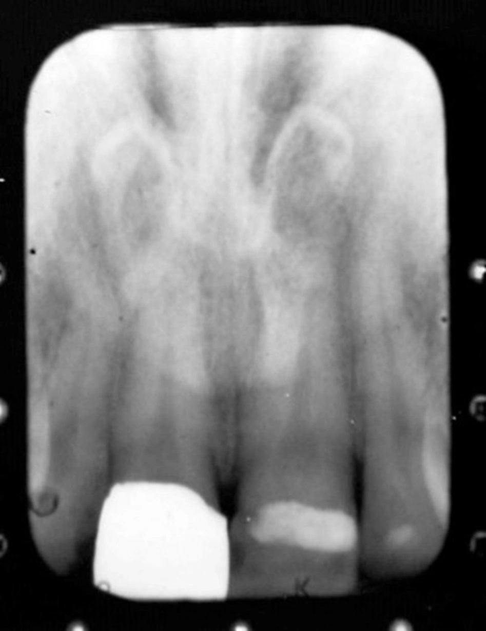 Resorptive Processes - Anomalies of Tooth Structure - Dentalcare