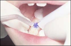 Step Four – Rinse and Dry the Tooth Surface | Sealants: The Added Link ...