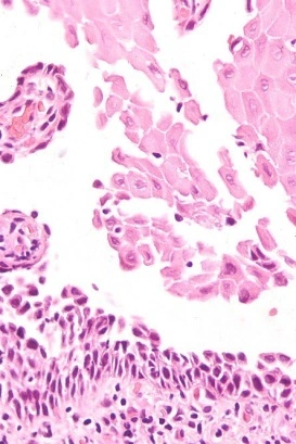 Diagnostic Information | Multiple Intraoral Ulcerations | dentalcare.com