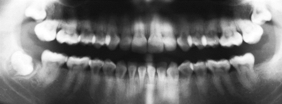 Loss of Tooth Structure - Anomalies of Tooth Structure - Dentalcare