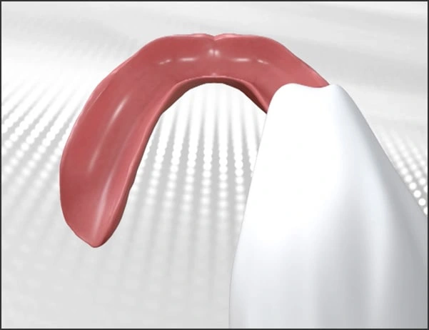 Appropriate Application of Denture Adhesive | Prosthesis Retention and ...