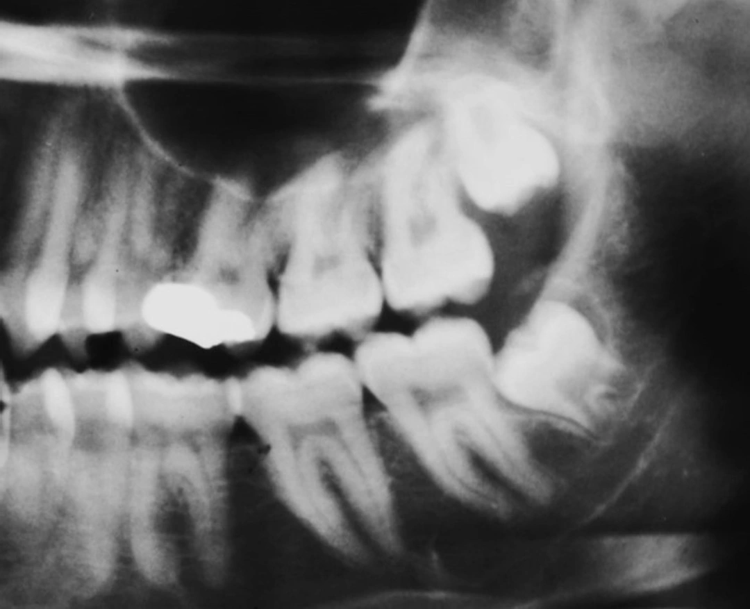 Alterations in the Number of Teeth - Anomalies of Tooth Structure ...